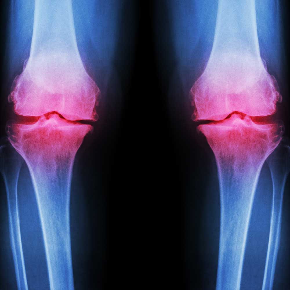 Knee Replacement - Cyprus Orthopaedic Sevices